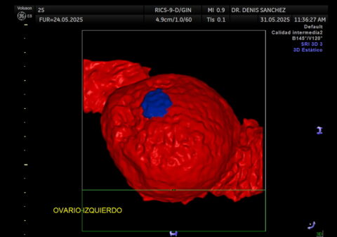 Quistes y tumores de ovario: diagnóstico, síntomas e índice ROMA