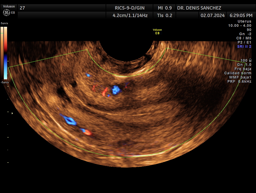 Engrosamiento endometrial en ecografía: causas y diagnóstico